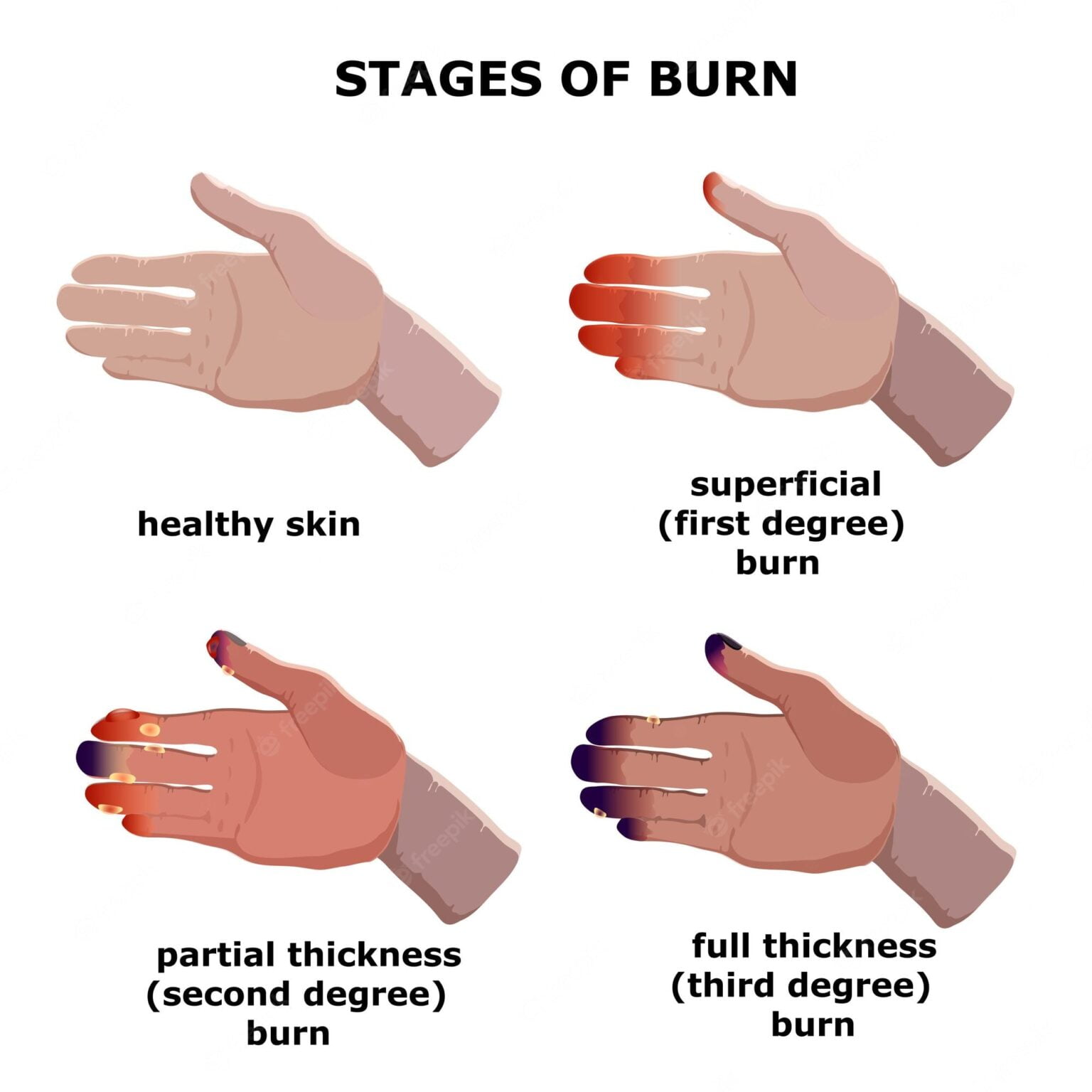 Burn Types Treatment And Nursing Management Medical Surgical Burn Types Treatment And Nursing Management Medical Surgical